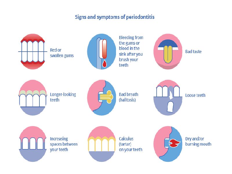 Periodontitis information leaflet | Content | MedAll