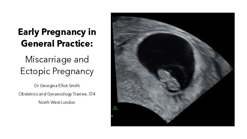 Miscarriage and ectopic pregnancy | Content | MedAll