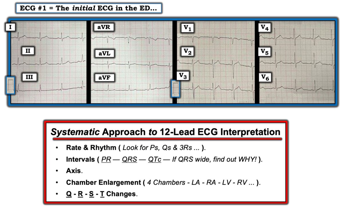 12-Lead ECGs- Talk-6 (OMI vs STEMI Criteria — Why Did the Patient Die ...